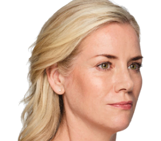 Dermal Filler | Refine Medical Aesthetics