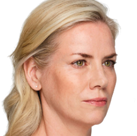 Dermal Filler | Refine Medical Aesthetics